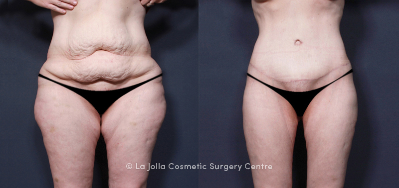 Does Medicaid Cover Skin Removal Surgery Ga Fashion